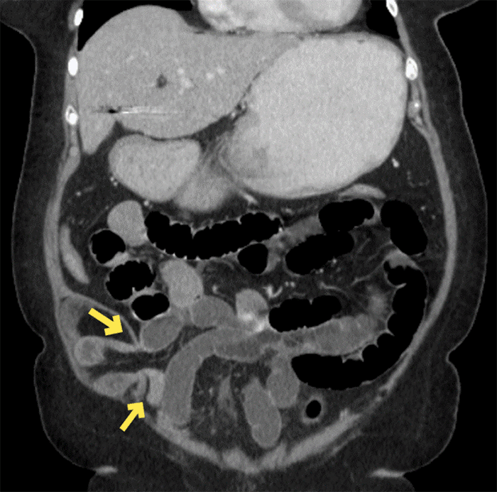 A Case of an Incisional Spigelian-Type Hernia | ACS