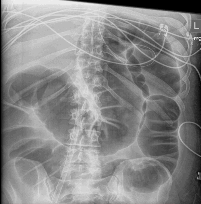 Colonic Paralytic Ileus in COVID-19 Patients | ACS