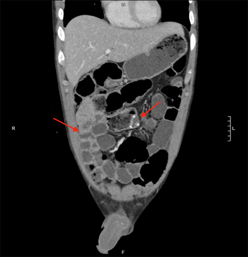 Internal Hernia of Ileocolic Anastomosis through Mesenteric Defect from ...