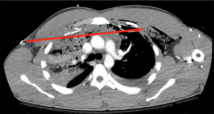 A Hemodynamically Stable Patient with a Transmediastinal Gunshot Wound ...