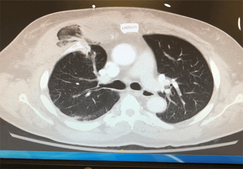 Hyperkinetic Biliary Dyskinesia in Adults: Cholecystectomy as a ...