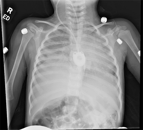 Misplacement of an Internal Jugular Chemo-Port into the Epidural Space ...