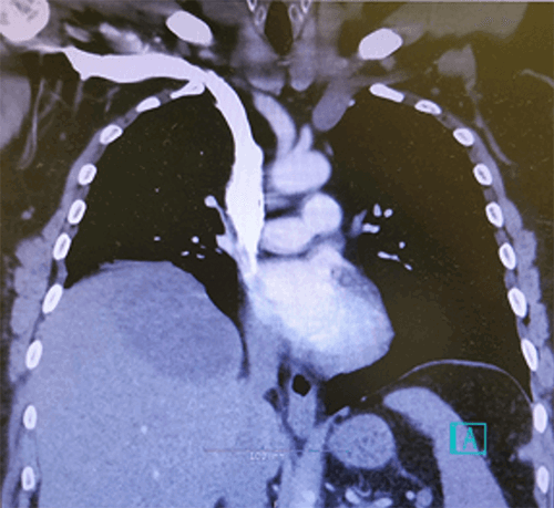 Transdiaphragmatic Liver Abscess Secondary to Streptococcus Milleri in ...