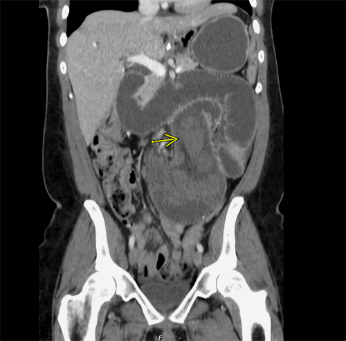 Recurrent Retrograde Intussusception Despite Revision of Jejunojejunal ...