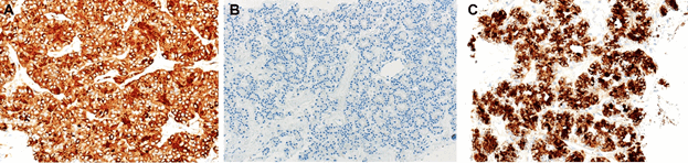 Primary Acinar Cell Carcinoma of the Liver Complicated by Pancreatic ...