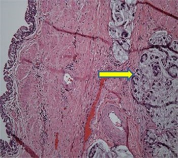 Signet-Ring Cell Cancer of Colon 48 Years after Ureterosigmoidostomy ...