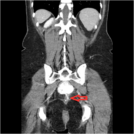 Recurrent Ileal J Pouch Volvulus | ACS